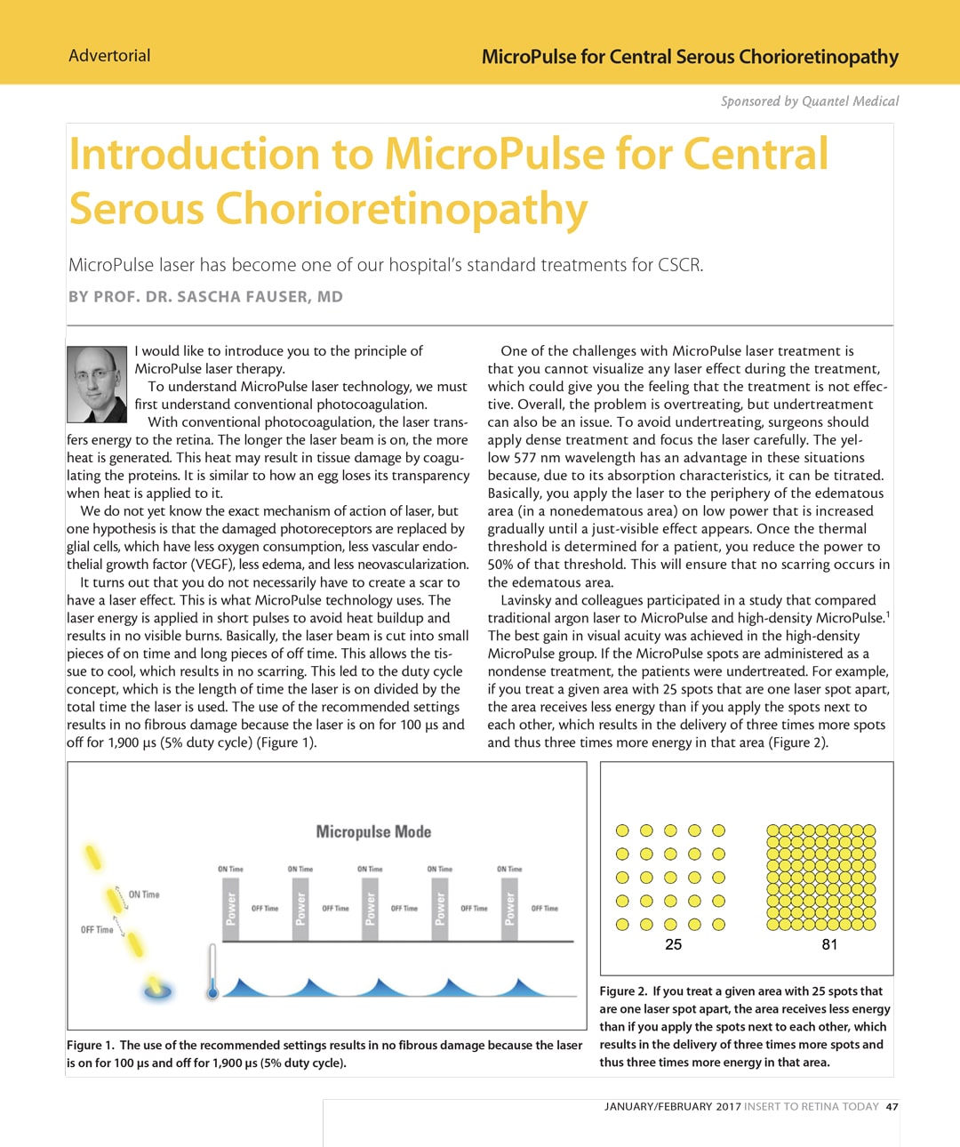 Introduction to MicroPulse for Central Serous Chorioretinopathy ...